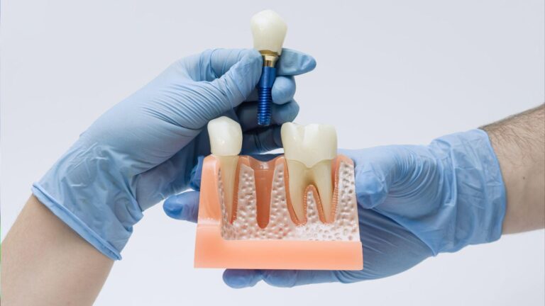 Short Implants: When Bone Height Is Limited and Grafting Is Not ...